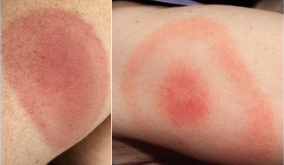 HSE warning as they share pictures of odd rash that could signal deadly ...